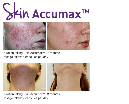 Mediskin: Skin Accumax - For Breakouts, Congestion and Acne