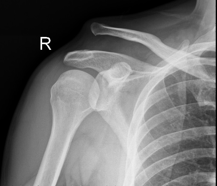 Sports and ACL Injuries: Shoulder Separations