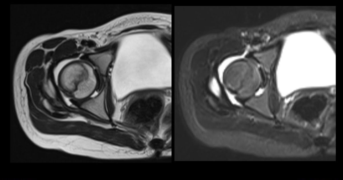 Ultimate Radiology : Transient Synovitis of Hip Joint