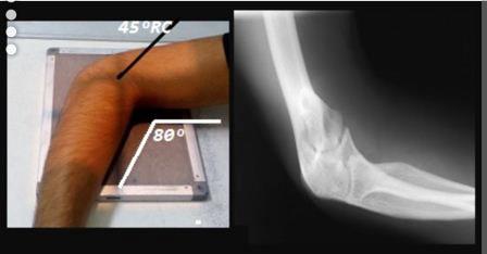 Cotovelo- Metodo de Coyle