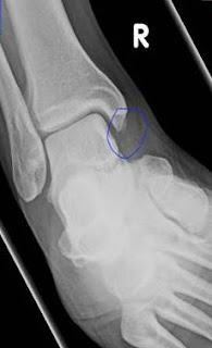 Medial Malleolus Ossicle - Sumer's Radiology Blog