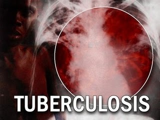 Penyakit Tuberkulosis (TBC) | BIOLOGIPEDIA
