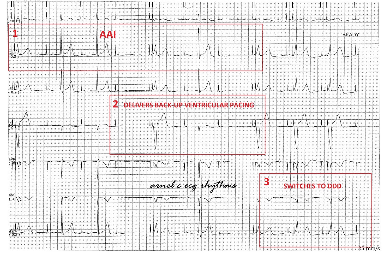 ECG Rhythms: Managed Ventricular Pacing