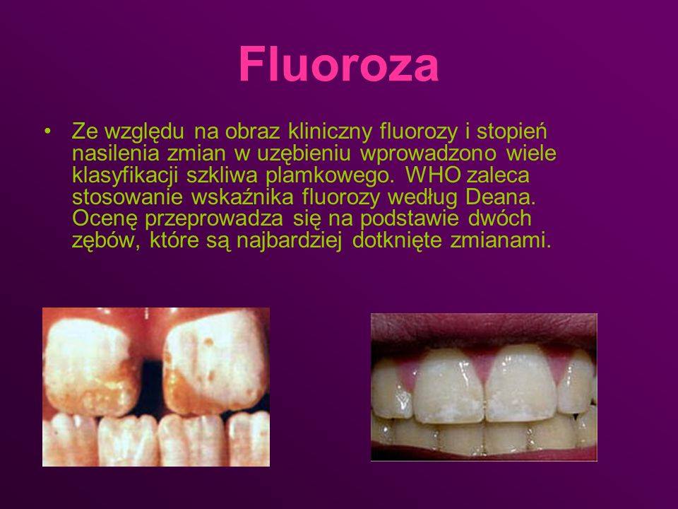 Stomatologia dla profesjonalistów: FLUOROZA