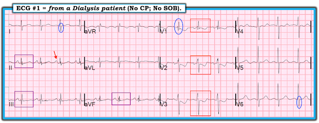 Dr. Smith's ECG Blog: ST Depression and T-wave inversion in V2 and V3.