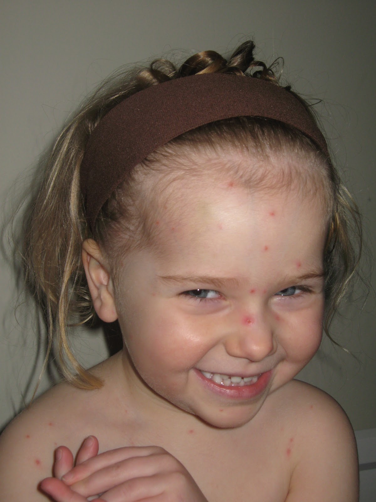 Me and my shadow: How to cope with Chicken Pox