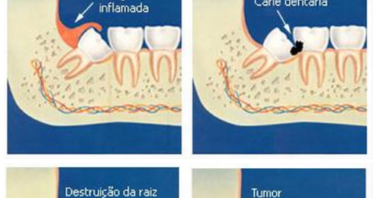 Referência em Bucomaxilofacial: Dentes Sisos