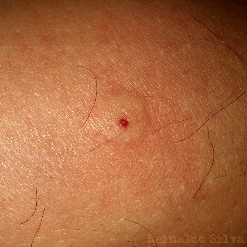 Insetologia - Identificação de insetos: Picada de Percevejo Predador ...