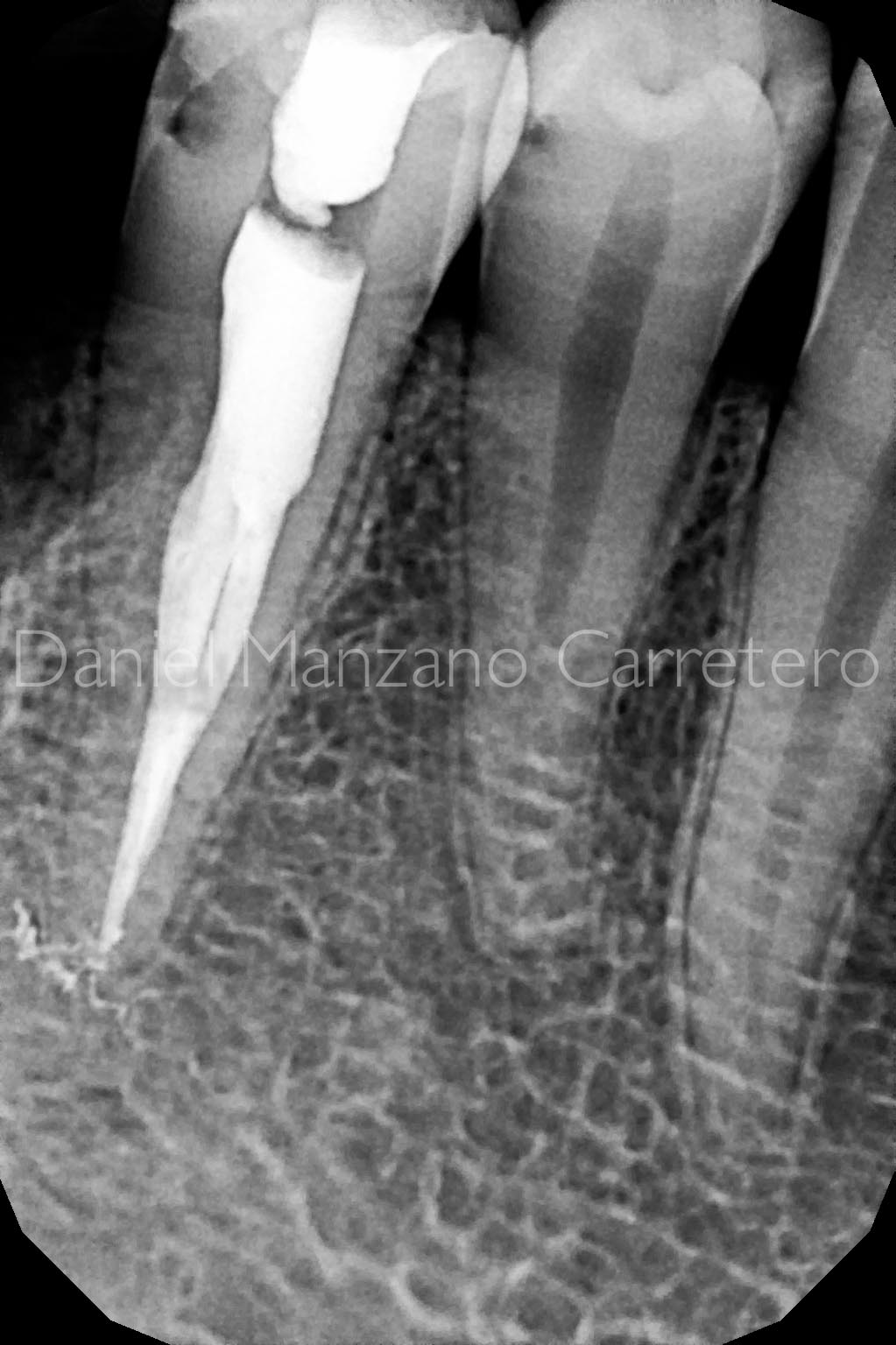 CASO CLÍNICO: 45 Tipo III de Vertucci