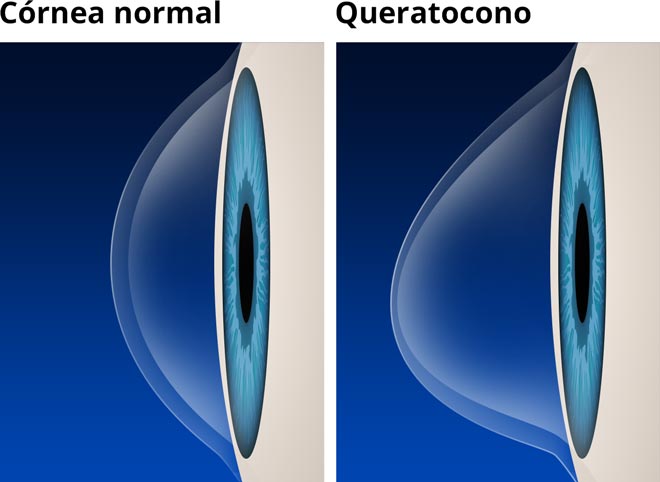 Clínica de Ojos Oftalmic Láser: ¿Qué es un Queratocono?