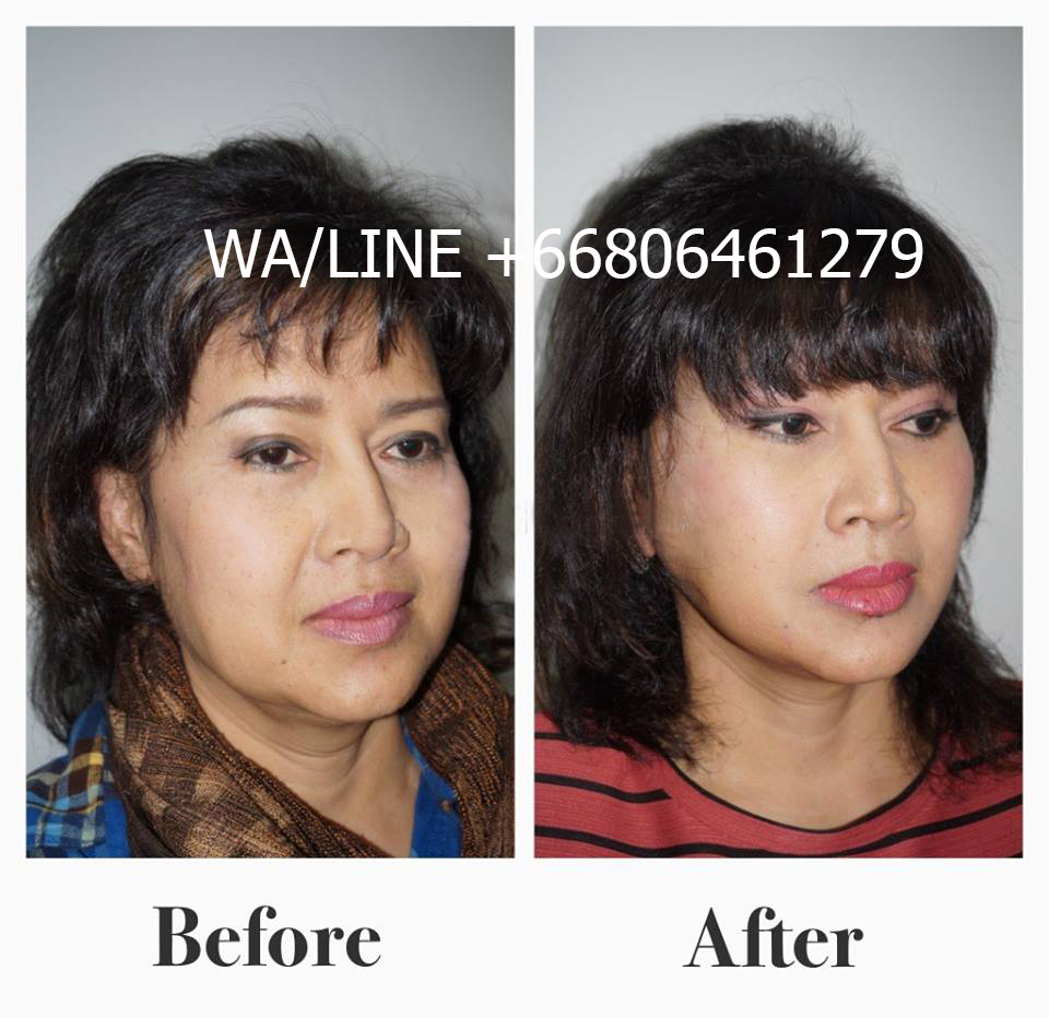 Bedah Plastik Di Bangkok: TARIK MUKA