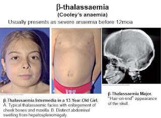 Klinik Medilove Kepong: Thalassemia