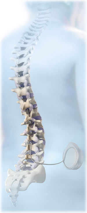 Skylers Back: Baclofen Pump