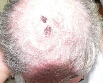 Pictures of skin cancer: Skin cancer scalp