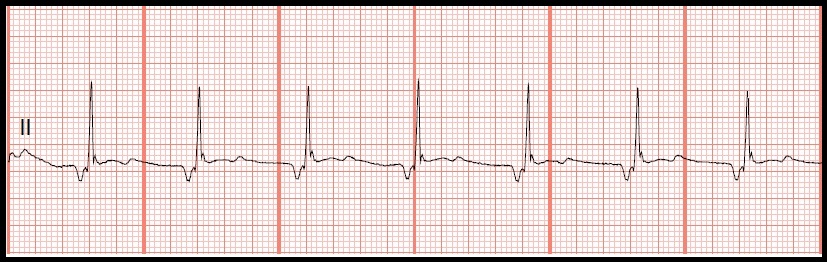 Characteristics of Junctional Rhythms