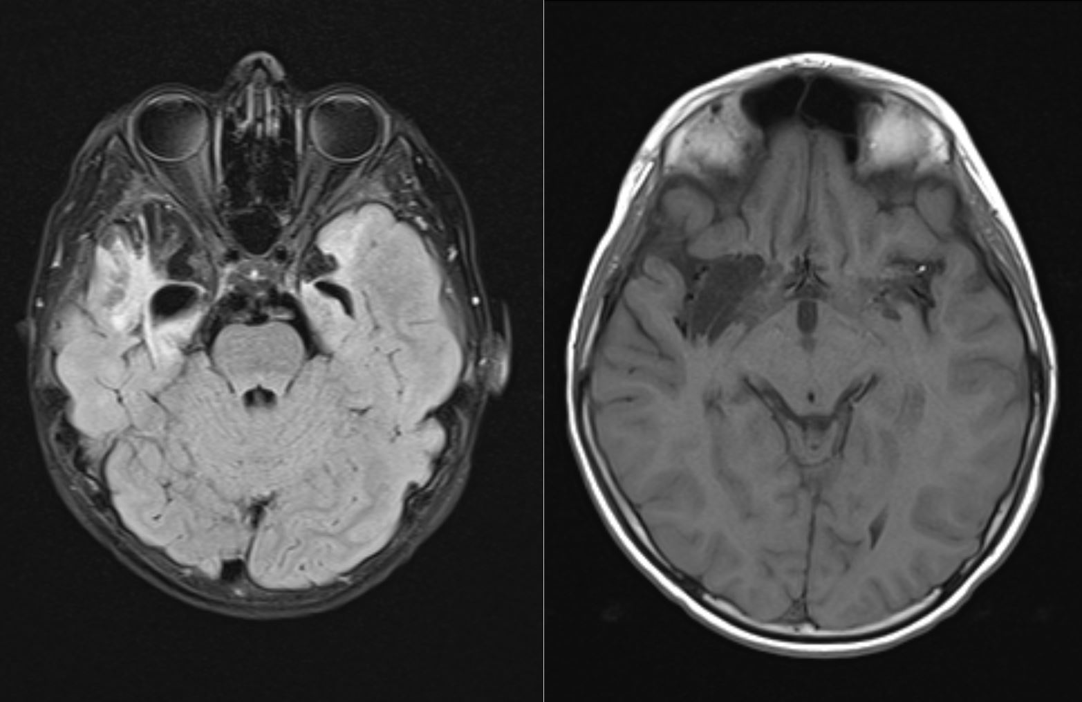 Herpes Simplex Encephalitis