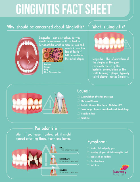 What is Gingivitis? ~ Kauvery Hospitals