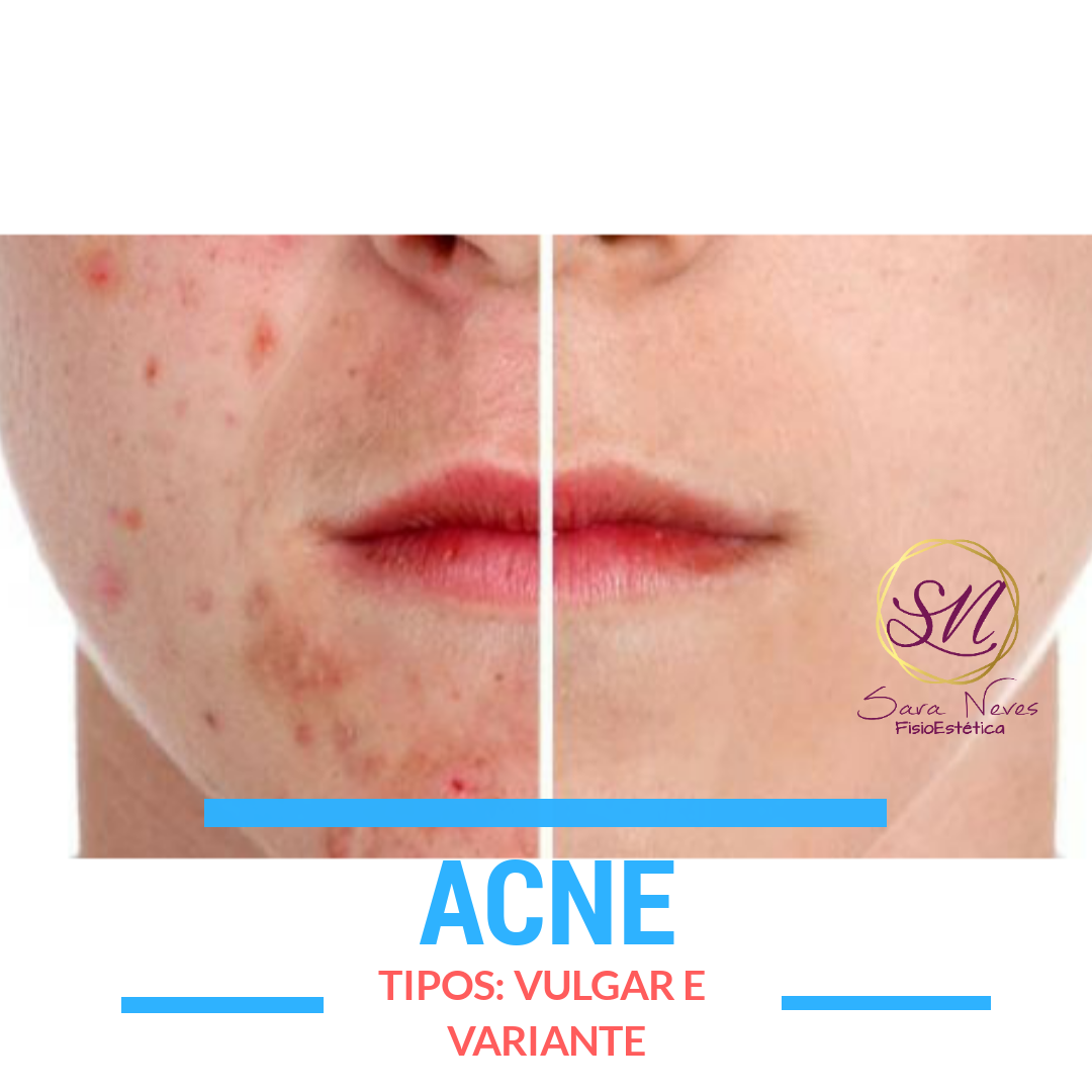Acne Vulgar e Variante | FisioEstética