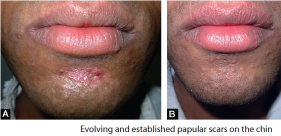 Morphological Types of Acne Scars - Treatment of Acne Scars