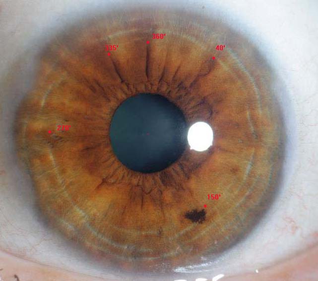 Modern & Multidimensional Iridology: Lipemic Diathesis, Hypertrophy ...