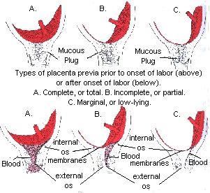 KEBIDANAN: PLASENTA PREVIA