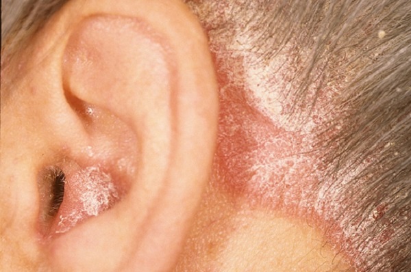 Signs And Symptoms Of Psoriasis In The Ears!