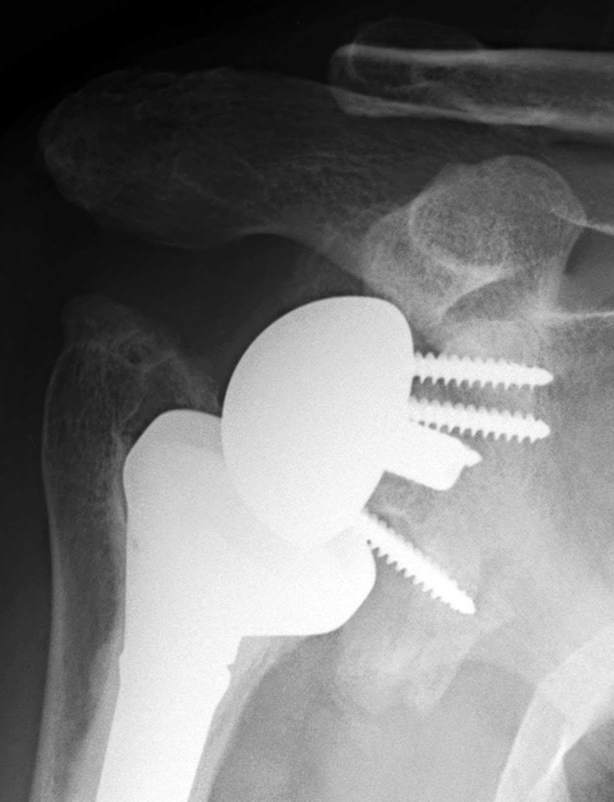 UW Shoulder and Elbow Academy: Reverse total shoulder joint replacement ...