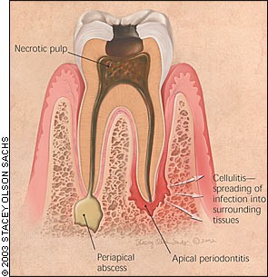 Periapical Abscess | Healthy Natural Life