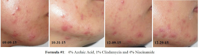 Review: Curology (formerly Pocketderm)