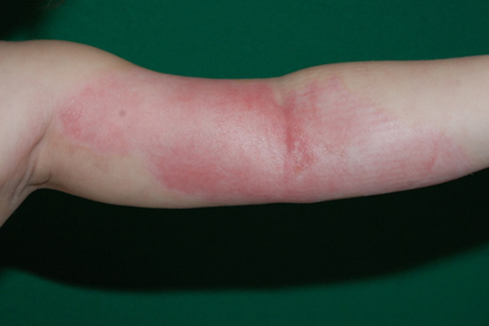 ECC EDUCATION: Pediatric Case of the Week 19: Burn