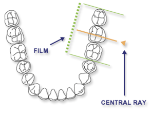 Dentistry and Medicine: Intraoral Radiographic Techniques (Paralleling ...
