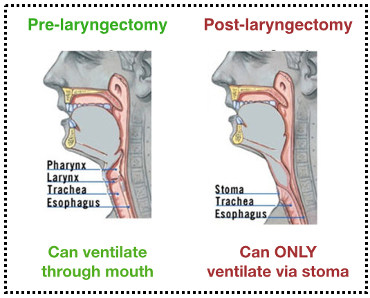 Everyday E(B)M: For the Sake of the Trach: Tracheostomy Basics ...