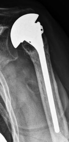 Shoulder Arthritis / Joint Replacement : Shoulder fracture dislocation ...