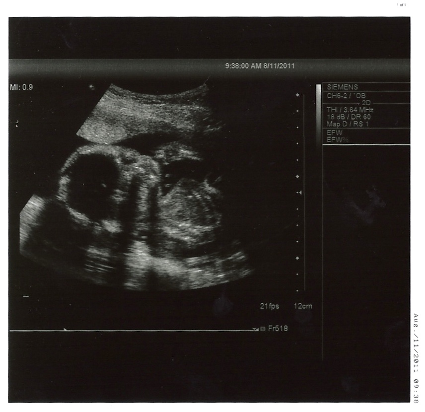 boicefamily: Ultrasound 22 weeks (last week)