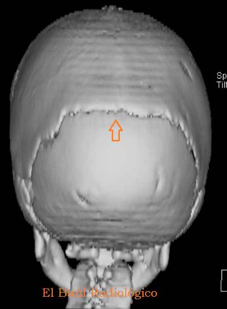 El Baúl Radiológico: CRANEOSINOSTOSIS. CIERRE PREMATURO DE LAS SUTURAS ...