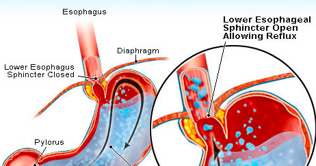 KSJBIO: #159 Reflux Esophagitis (English)