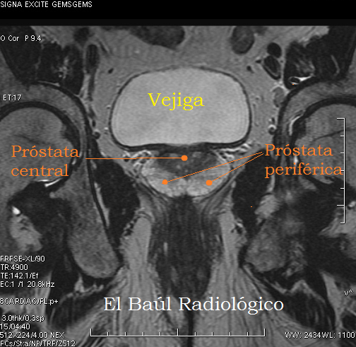 El Baúl Radiológico: ESPECTROSCOPIA PROSTÁTICA MEDIANTE RESONANCIA ...