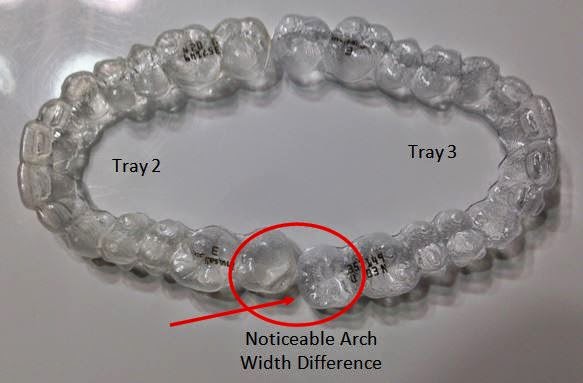 My Invisalign Chronicles: Week 5 - Tray Set 3 & Progress Update