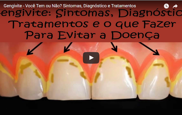 Tudo o que Você Precisa Saber Sobre Gengivite: Sinais, Sintomas ...