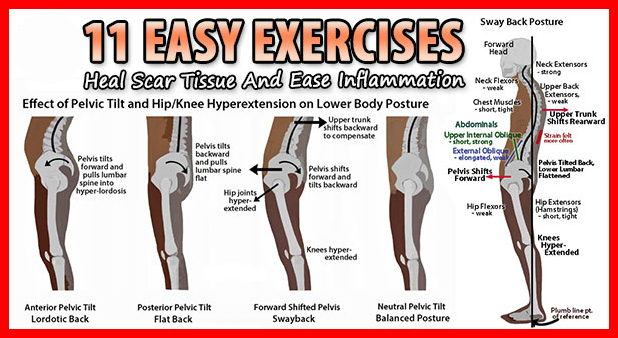 11 Easy Exercises To Heal Scar Tissue And Ease Inflammation | Top ...