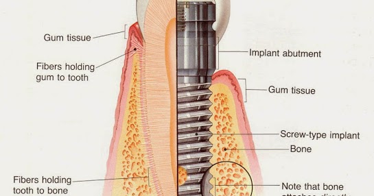 OSSEOINTEGRATION: Why is biocompatible the titanium used for dental ...