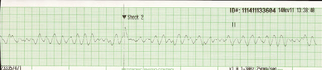 Pediatric Pulseless Ventricular Tachycardia (VT) and Ventricular ...