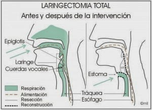 Plan de Cuidados a un Paciente con Laringectomia