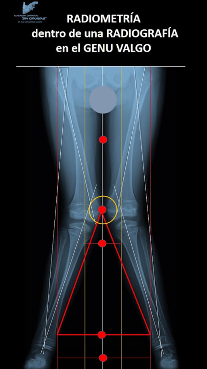 SIN CIRUGÍAS en LÍNEA: LA DINÁMICA del GENU VALGO
