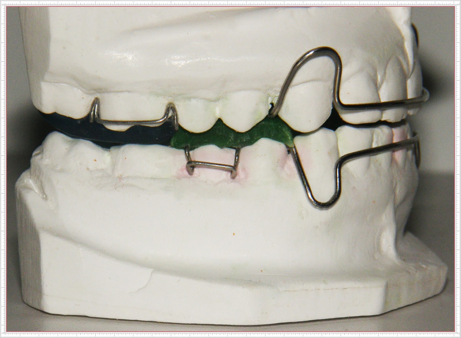 Функционални ортодонтски апарати ~ Медико-техническа ортодонтска ...