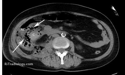 RiT radiology: Blunt Traumatic Colon Perforation