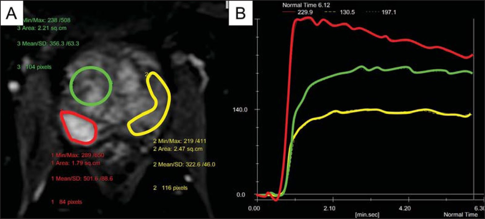 Journal and Conferences on Biomedical Engineering: Intraductal ...
