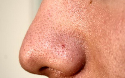 Cara Cepat Membersihkan Komedo Yang Menganggu Secara Alami Sehat ...