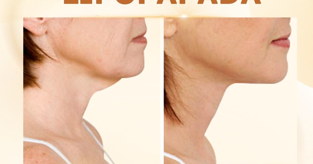 LIPOPAPADA COM DRA. KATYANNE HENRIQUES