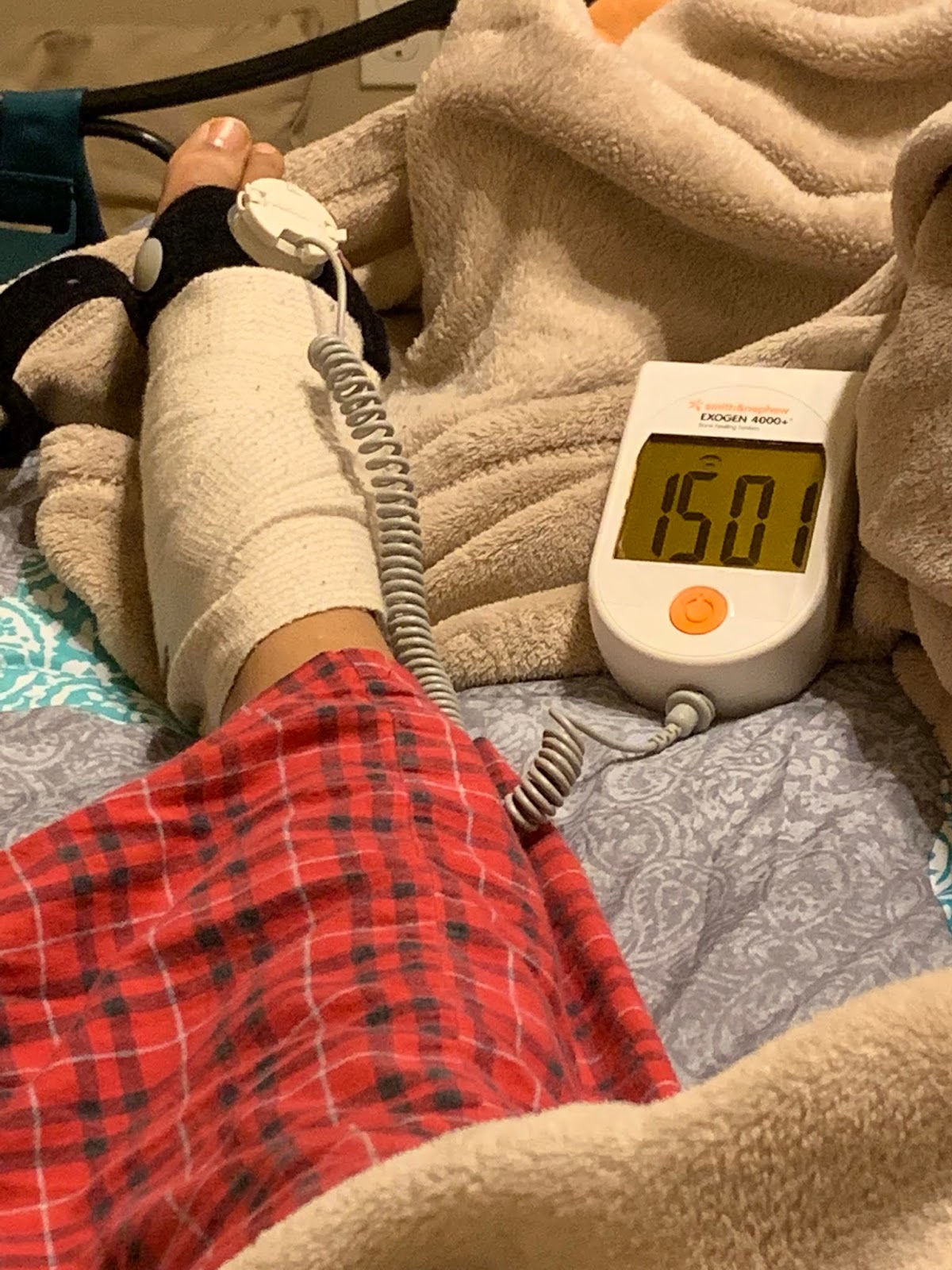 All About My 1st MPJ Foot Fusion